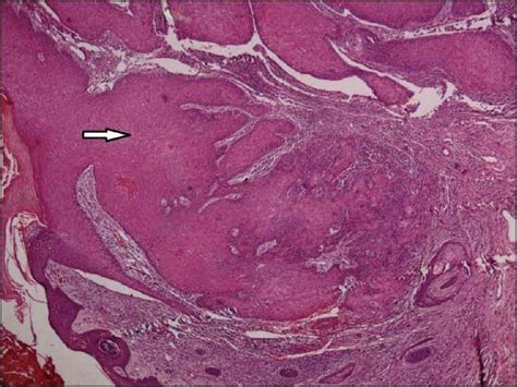 Pseudoepitheliomatous Hyperplasia A Clinical Entity Mistaken For