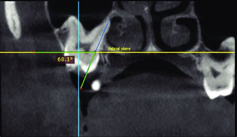 Evaluation Of The Angle Formed Between The Longitudinal Axis With The Download Scientific
