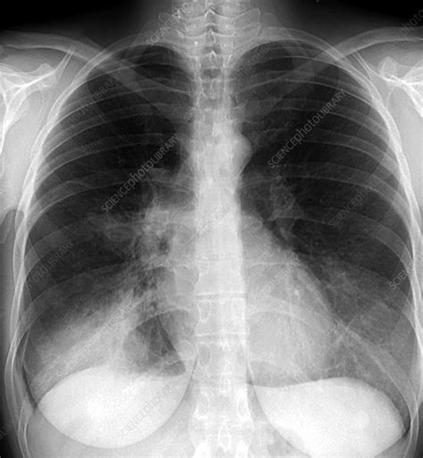 Chest Infection X Ray Stock Image C0267923 Science Photo Library