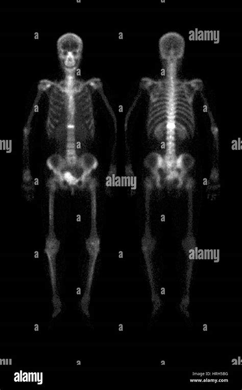T Compression Fracture Hi Res Stock Photography And Images Alamy