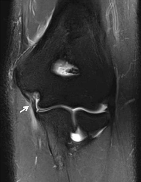 Coronal T2 Mr Arthrogram Of The Elbow Demonstrates A High Grade Partial