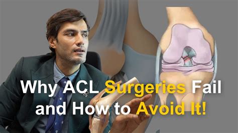 Why ACL Surgeries Fail and How to Avoid It! - YouTube