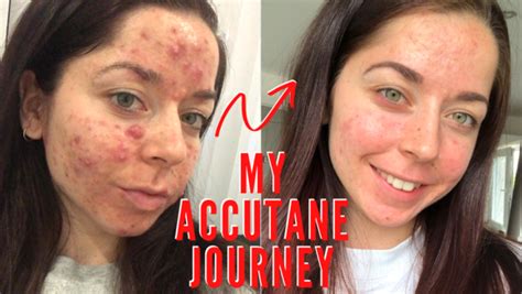 Roaccutane Side Effects