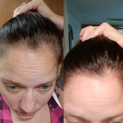 Can You Regrow Thinning Hair Naturally Semi Short Haircuts For Men