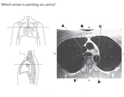 Axial Mri Of Chest Ascendingdescending Aorta Quiz Axial Mri Of Chest Ascendingdescending Aorta Quiz