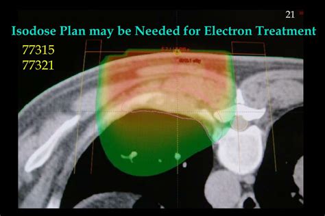 Ppt Section 8 Radiation Oncology Dosimetry Cpt Codes 77300 77370