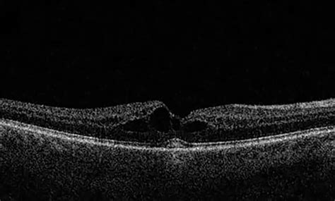 A Case Of Cystoid Macular Edema Associated With Maintenance Dose Ozanimod Retinal Physician