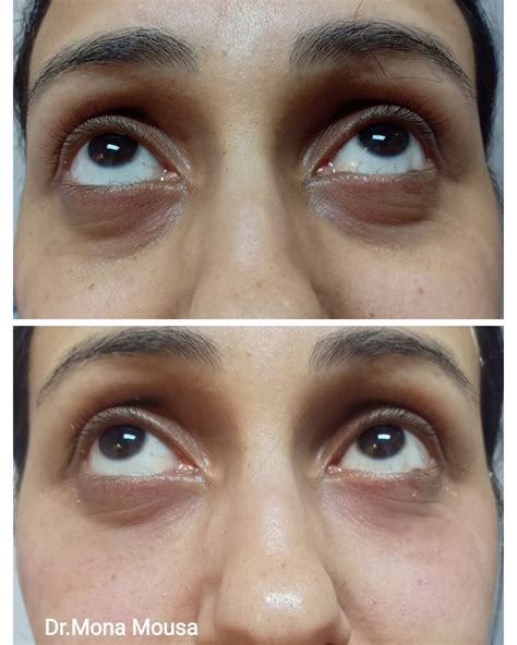 علاج تجويف العين عن طريق Özel Clinics Dr Mona Mousa