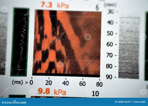Fibroscan Examination Study Of The Liver Revealed F2 For Liver Stiffness S3 For Liver Steatosis