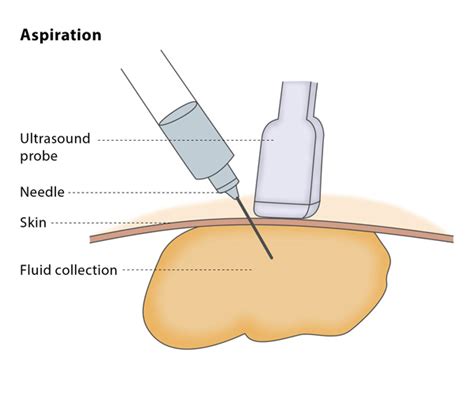 What Is The Cpt Code For Fine Needle Aspiration