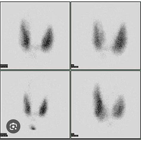 Radioactive Iodine Uptake Test