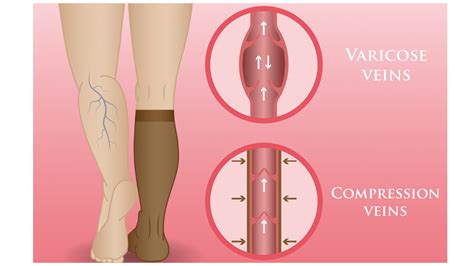 Lower Extremity Compression Socks Everything You Need To Know Bioanadrasis