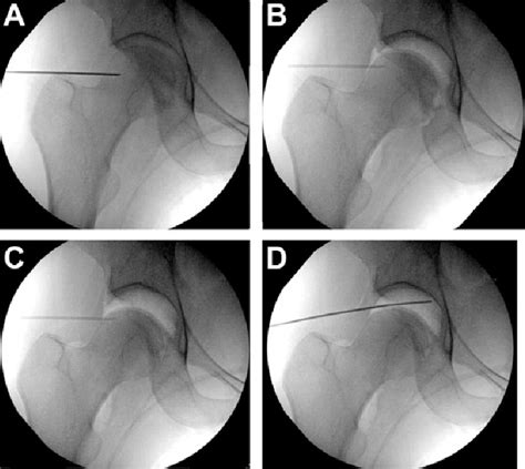 A A 17 Gauge Spinal Needle Is Used To Penetrate The Hip Joint Capsule