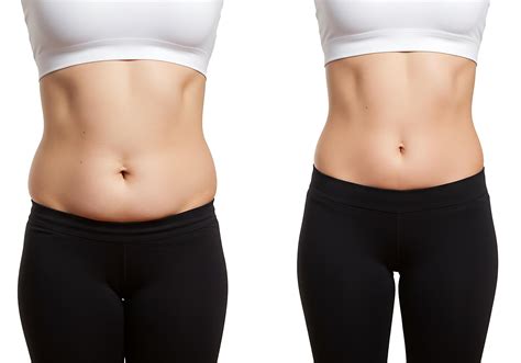 Before And After Image Of A Womans Stomach Before And After A Tummy