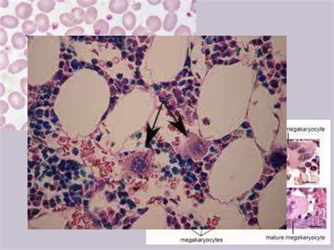 Platelet Disorderspptx