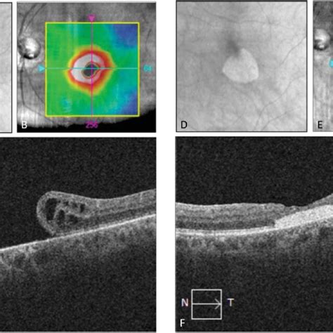 Optical Coherence Tomography Fundus Ilm Rpe Thickness Map And Download Scientific Diagram