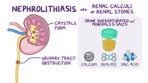 Video Nephrolithiasis Clinical Sciences Osmosis