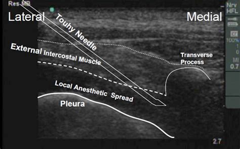Usra Thoracic Paravertebral Block
