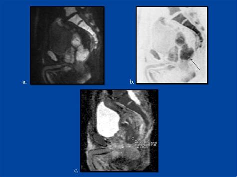 Figure 4 From Role Of Sagittal Dwi In Detection Of Lymph Node Involvement In Patients With
