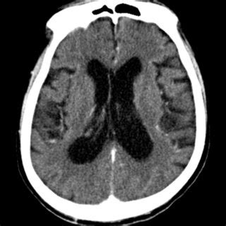 Brain Computed Tomography Showed Moderate Diffuse Brain Atrophy Download Scientific Diagram