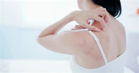 Tanning Bed Rash On Buttocks How To Treat It And Prevent It Good