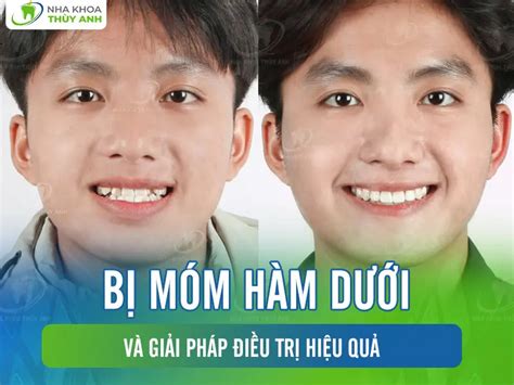 Bị Móm Hàm Dưới Và Giải Pháp điều Trị Hiệu Quả