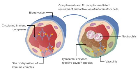 Type Iii Hypersensitivity Reaction Concise Medical Knowledge