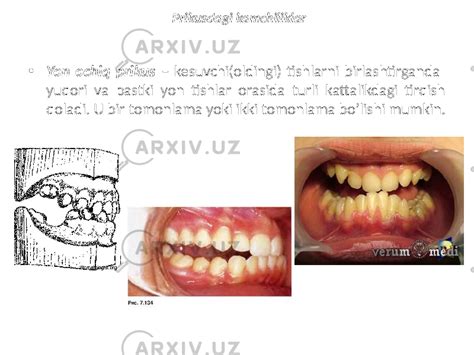 Dislaliya Shakllari Va Turlari Pedagogika Slaydlar