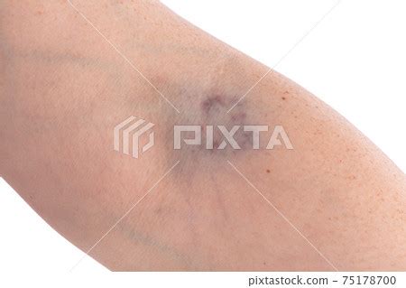Plasma Donation Scars