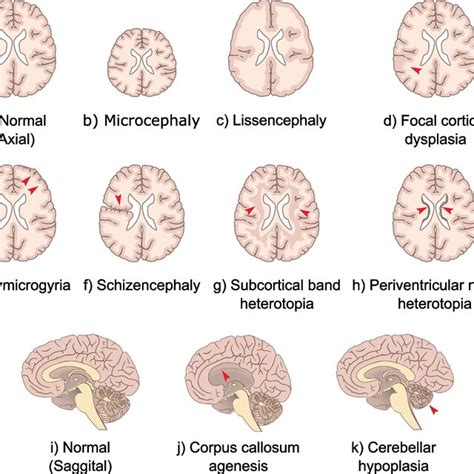 Schematic Representation Of Cortical Development In Human Brain Along