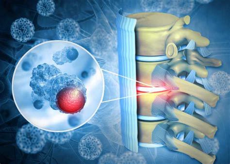 Spinal Hemangioblastoma Spine Cancer Specialist St Louis Creve