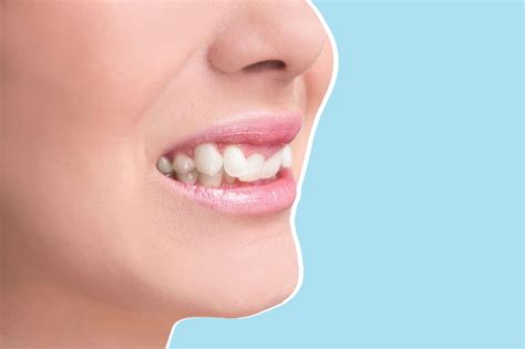 Symptoms And Causes And Solution How To Treat Teeth Shifting Toothsi By