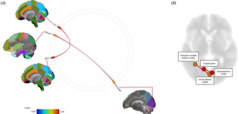 Comprehensive Elucidation Of Resting State Functional Connectivity In Anorexia Nervosa By A