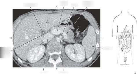 Test 2 Sectional Anatomy Liver Gb Pancreas Session 4 Diagram Quizlet