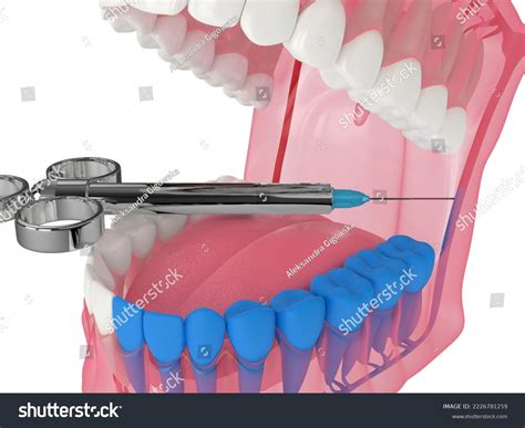 Inferior Alveolar Nerve Block Technique Video