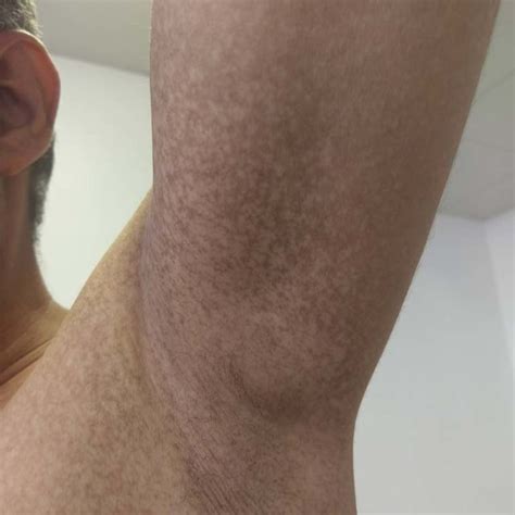 Reticulate Hyperpigmentation On Axilla Download Scientific Diagram