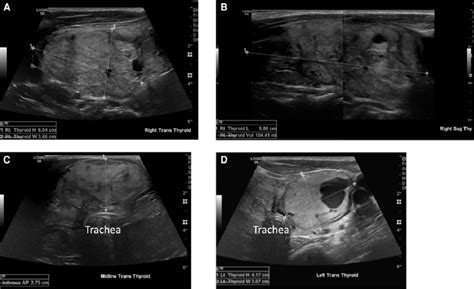 Thyroid Ultrasound Images 1 Month Before Radiofrequency Ablation Of Download Scientific Diagram