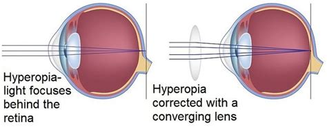 Hyperopia Diagram