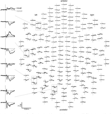 figure 1 from spatiotemporal maps of brain activity underlying word