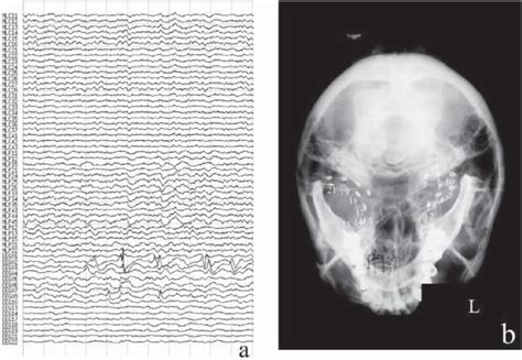 A B Simultaneous Meg And Invasive Eeg Recordings In A Patient With