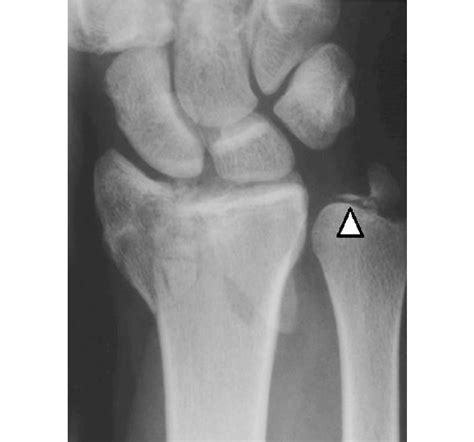 Ulnar Styloid Fracture X Ray At Carol Walsh Blog