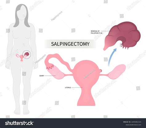 Female Uterus Biopsy Surgical Ovary Tubal Stock Vector Royalty Free Shutterstock