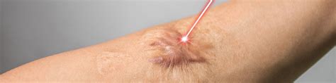 Keloid Scar Treatment In Chennai By Dermatologists Spade Skin Clinic