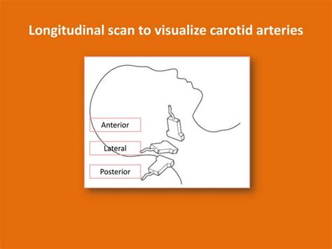New Carotid Doppler Ultrasound Pptx