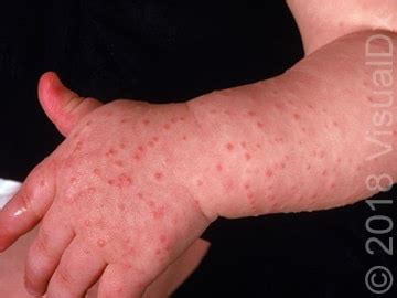Fnp Confirms Diagnosis By Triple Checking With Visualdx Visualdx