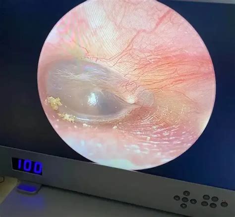 Laparoscopy Machine Hysteroscopy Set Usb Endoscope Camera 24inch