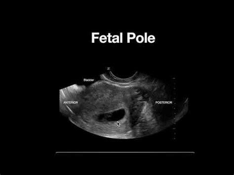 One Minute Image Review Ob Gyn — Tpa