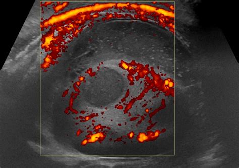 Scrotal Pyocele Pacs