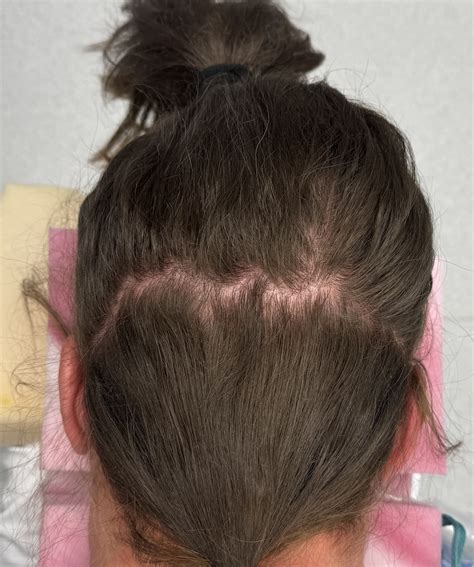 Scalp Tiisue Expander Intraop Positioning Back View Dr Barry Eppley Explore Plastic Surgery