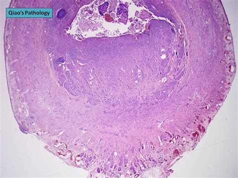 Qiao S Pathology Appendiceal Carcinoid Tumor Microscopic Flickr
